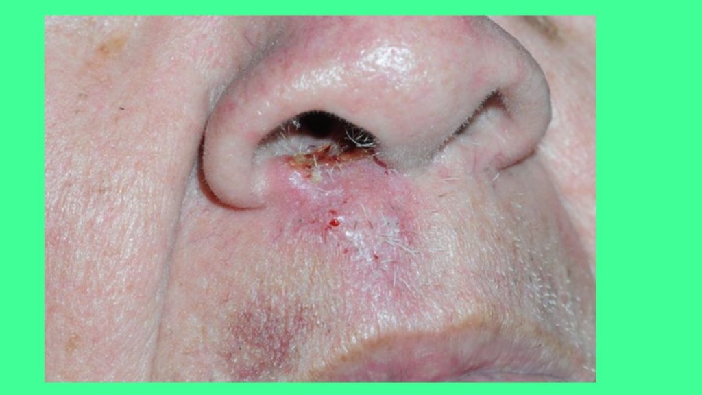 Colgajo de avance con pedículo subcutáneo, para reparar un defecto en ...