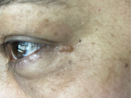Lesion vesicular angulo externo ojo izquierdo – PIEL-L Latinoamericana