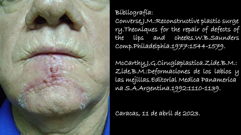 Un carcinoma Espinocelular en el labio inferior – PIEL-L Latinoamericana