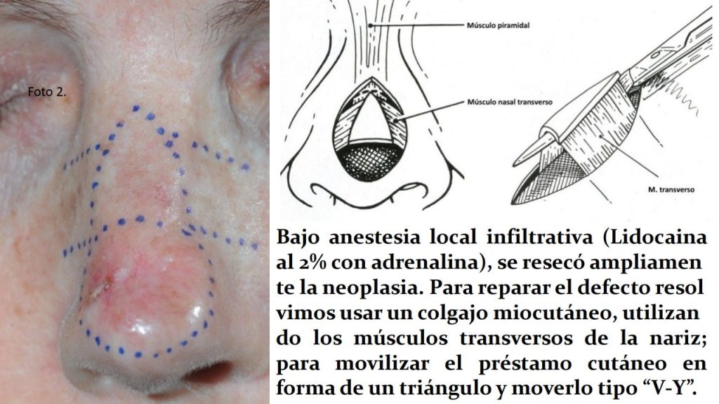 Colgajo miocutáneo en dorso nasal – PIEL-L Latinoamericana