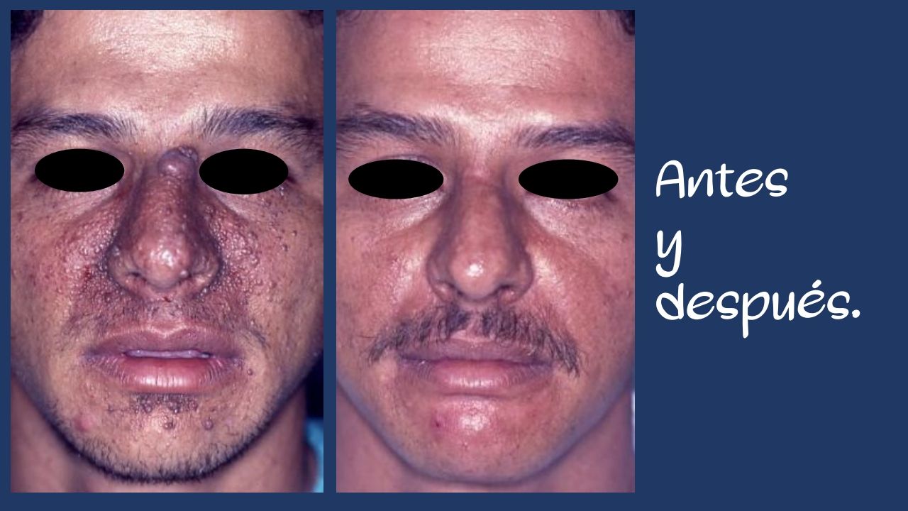 Angiofibromas de la esclerosis tuberosa. Tratamiento con dermoabrasión ...