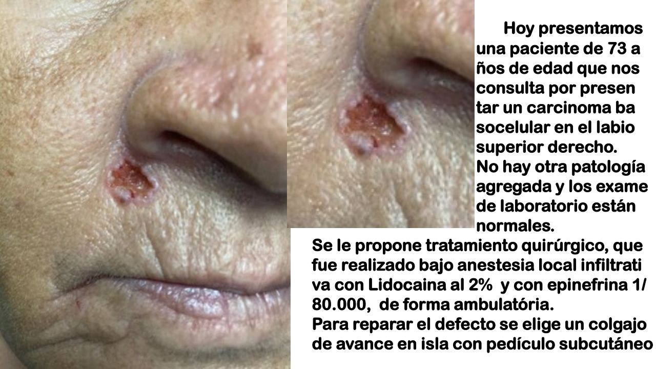 Colgajo de avance con pedículo subcutáneo – PIEL-L Latinoamericana