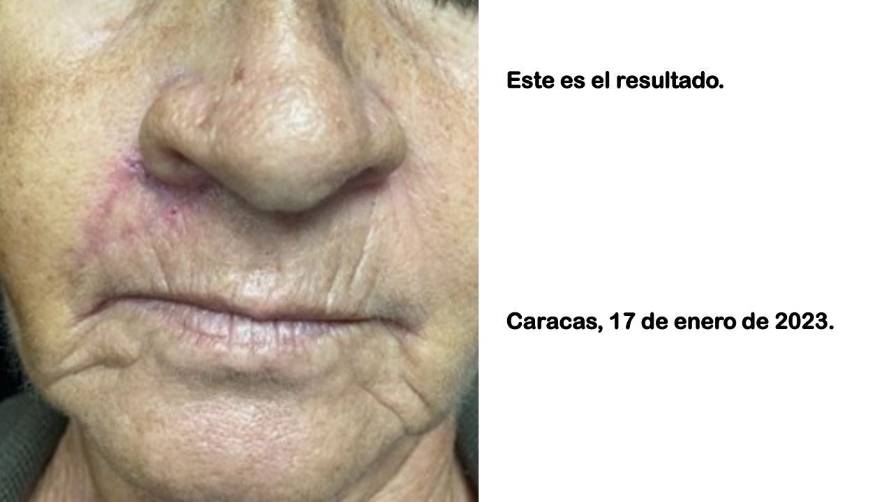 Colgajo de avance con pedículo subcutáneo – PIEL-L Latinoamericana