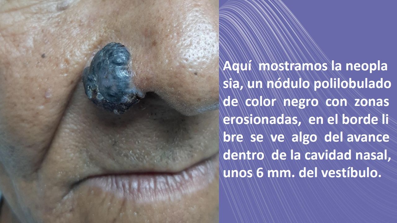 Resección de un carcinoma basocelular del ala nasal derecha – PIEL-L ...