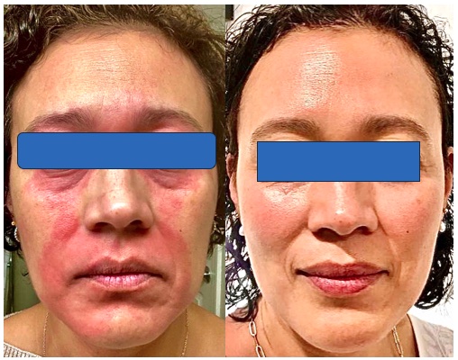 Tacrolimus y Etilismo. Un efecto no esperado – PIEL-L Latinoamericana