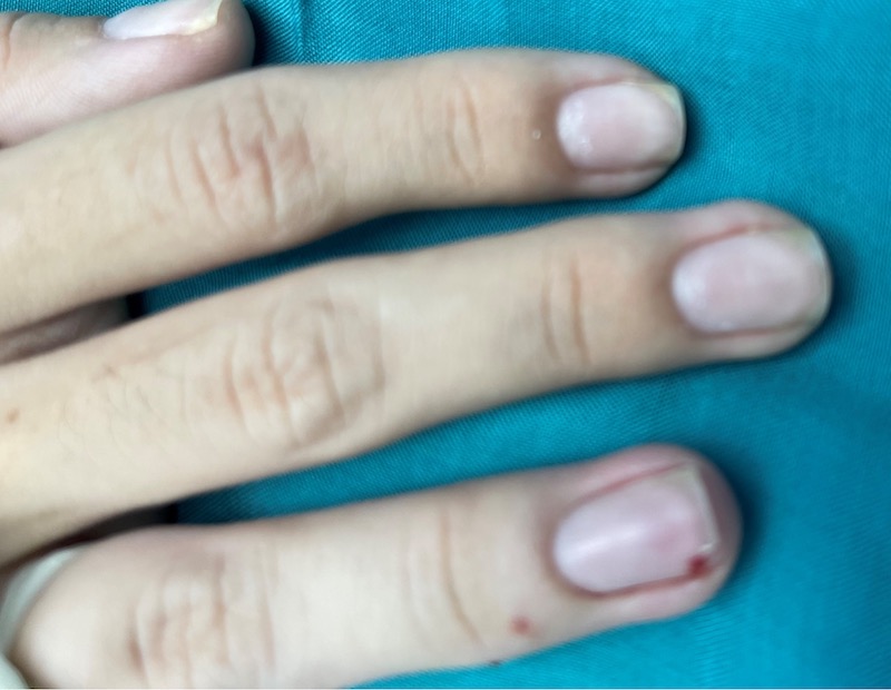 Lesión dolorosa en lecho ungueal del anular derecho – PIEL-L ...