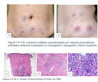 Infección cutánea por micobacteria no tuberculosa de crecimiento rápido ...