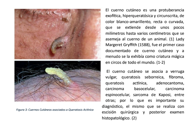 CARAS DEL CUERNO CUTANEO – PIEL-L Latinoamericana