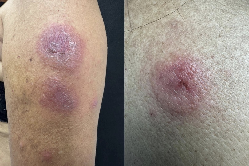 Lesiones placas nodulares en miembros superiores y tronco – PIEL-L ...